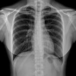 Harrison.ai CXR — AI Chest X-Ray Solution