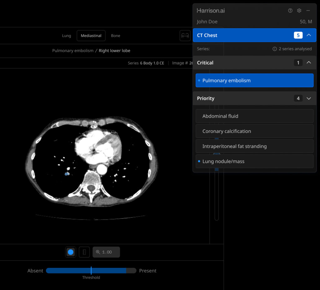 Harrison.ai CT Chest — Comprehensive AI Chest CT Analysis