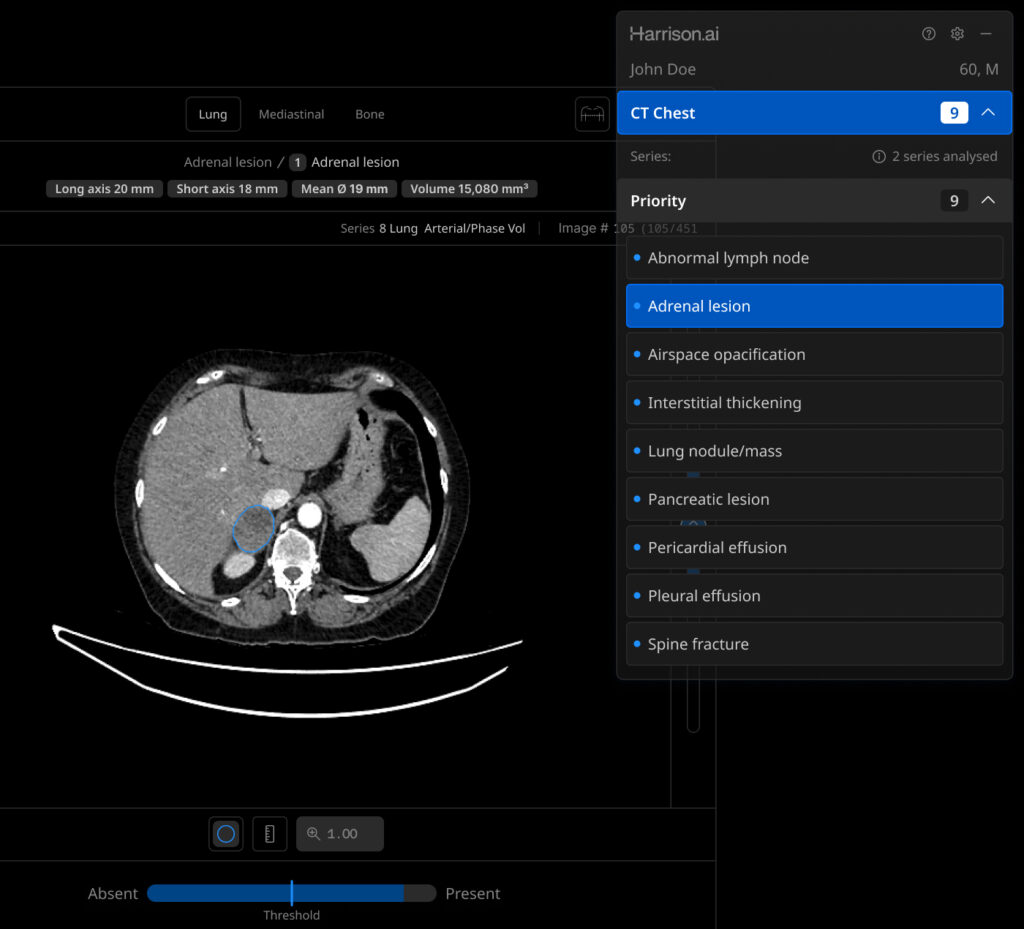 Harrison.ai CT Chest — Comprehensive AI Chest CT Analysis