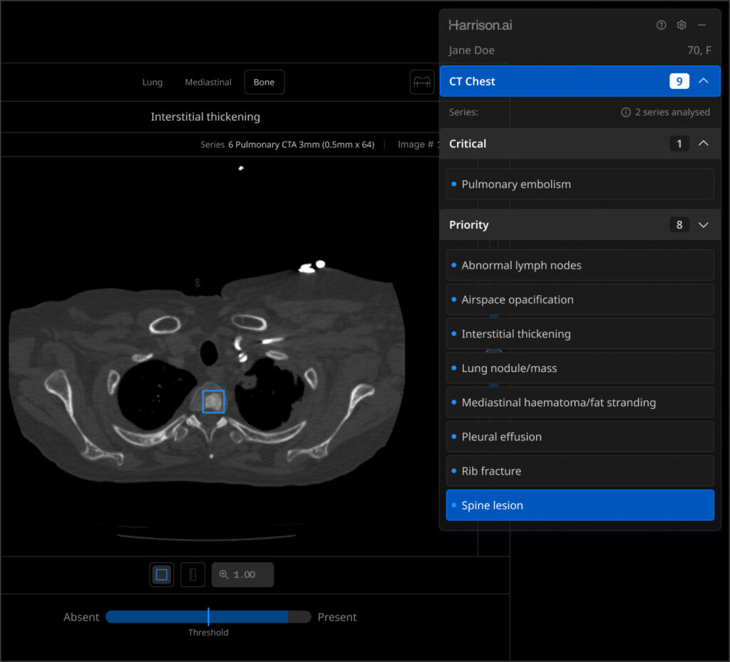 Harrison.ai CT Chest — Comprehensive AI Chest CT Analysis