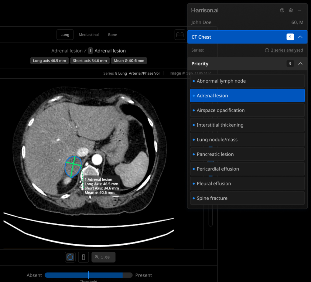 Harrison.ai CT Chest — Comprehensive AI Chest CT Analysis